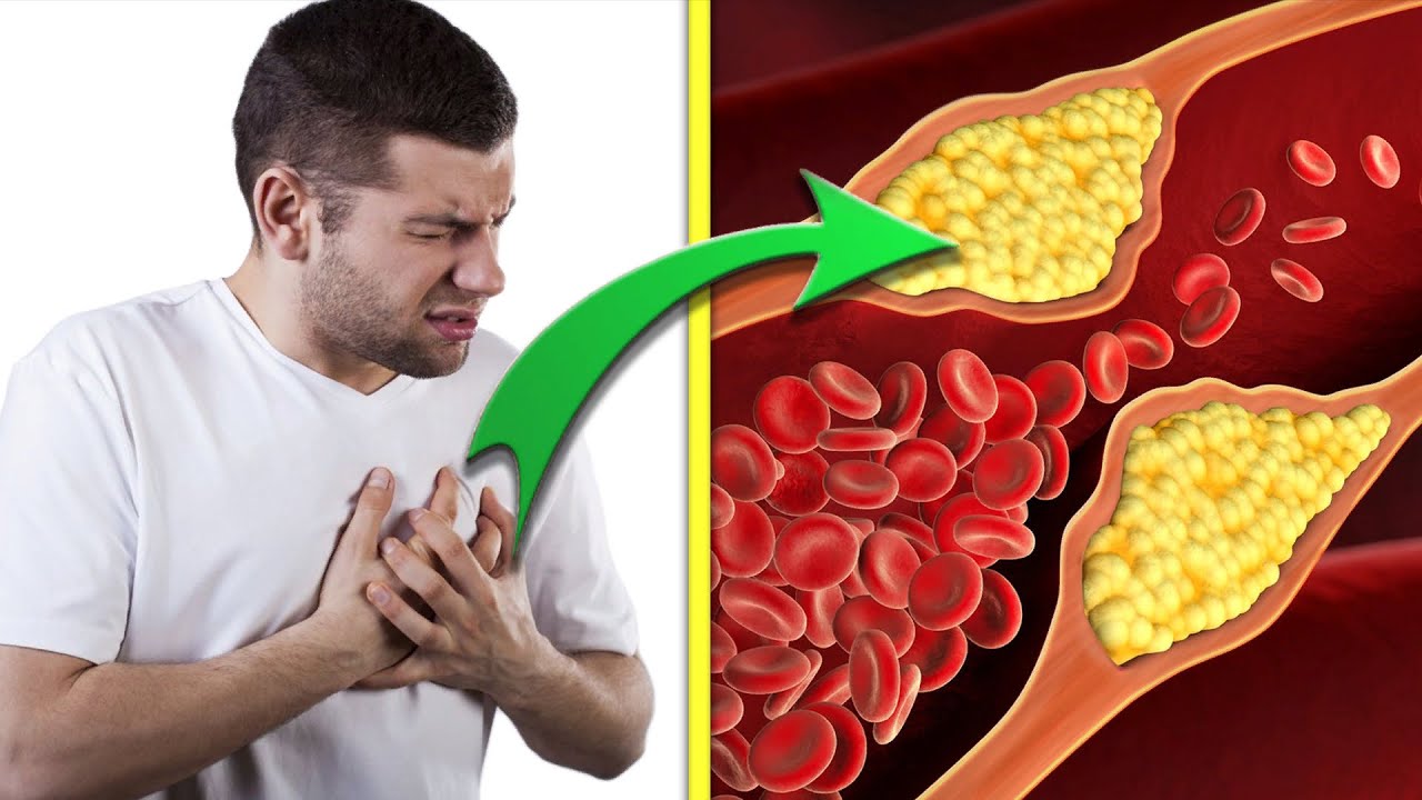 The Ultimate Guide to Lowering Cholesterol: Foods, Diet and Home ...